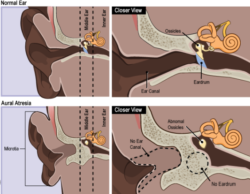 Atresia Surgery in Dallas, Frisco and Forth Worth - Dallas Ear Institute
