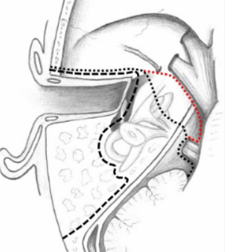 Ear Cancer Treatment in Dallas, Frisco, and Fort Worth - Dallas Ear ...