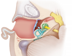 Canalplasty in Dallas, Fort Worth and Frisco, TX - Dallas Ear Institute