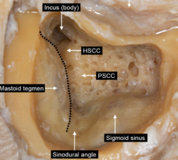 Mastoidectomy in Dallas, Fort Worth, Frisco, TX - Dallas Ear Institute