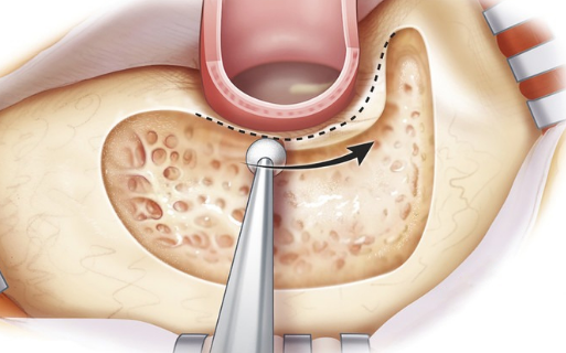Mastoidectomy in Dallas, Fort Worth, Frisco, TX - Dallas Ear Institute